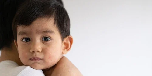 Mengenal Campak pada Bayi, dari Gejala hingga Penanganan